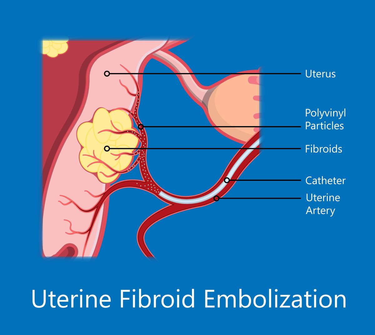 The Sad Truth About Hysterectomies Atlanta Fibroid Clinic