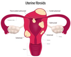 Understanding Fibroids: Types & Symptoms | Atlanta Fibroid Clinic